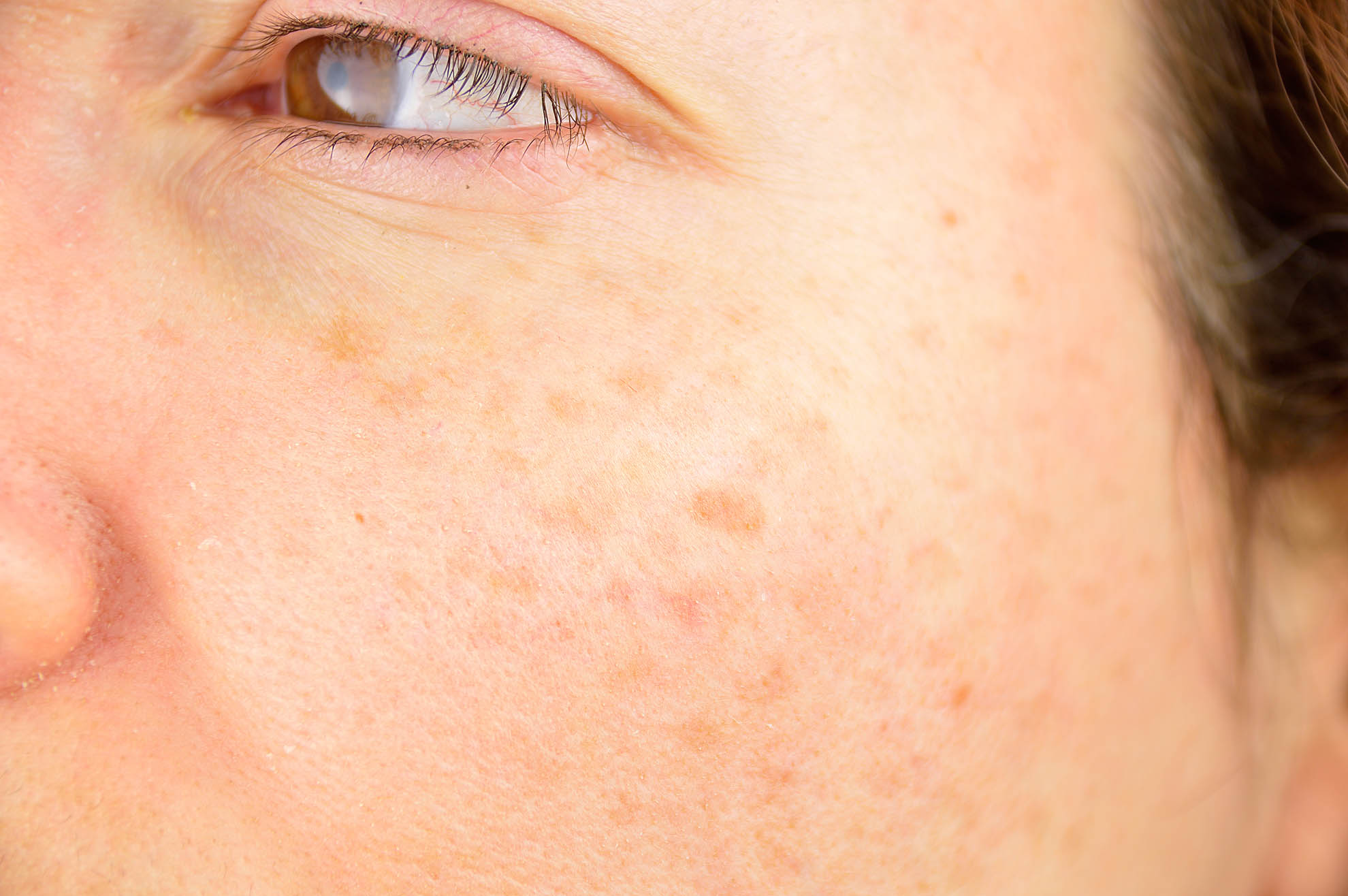 Treatment Options For Liver Spots Health N Well